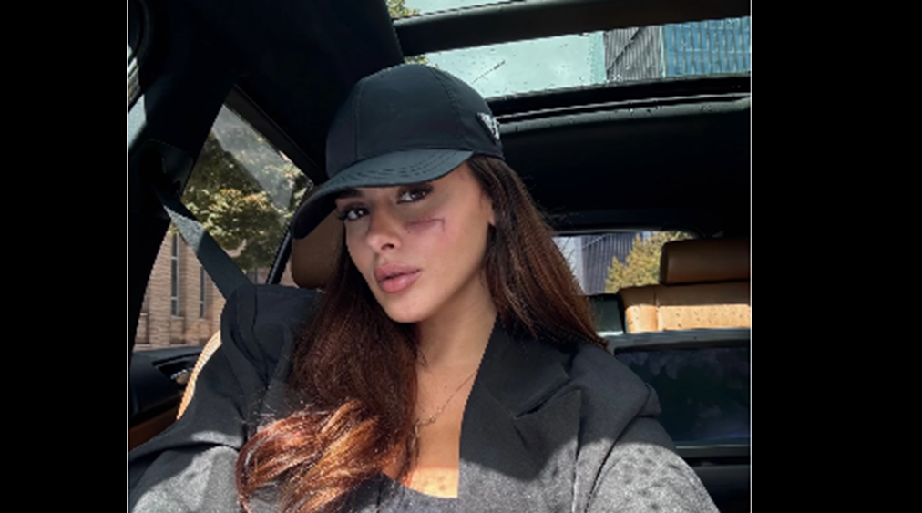 U rrah nga motrat Berisha, Klea Prenga tregon shenjën që i ka mbetur ...